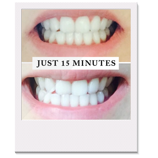 Pearly Whites - Special Offer 'Best Friends' Teeth Whitening Twin-Pack